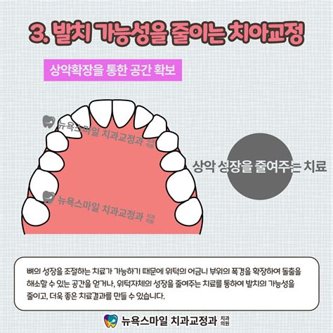중 고등학교 때 교정하면 좋은 점 여섯 가지 1편 1 미국 교정 전문의 부산 뉴욕스마일 치과