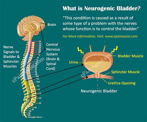 Neurogenic Bladdercausessymptomstreatment