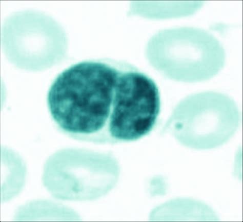 Lymphocytes Binucléés Observés Au Cours Dune Leucémie Lymphoïde