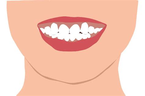 Fixing Snaggletooth Its Causes And Treatment Aligner32