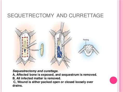 Saucerization Single Saucerization Biopsy Technique For Blistering