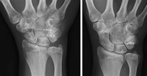 Scaphoid Length Measurements On Pa View Working Length Of The Scaphoid