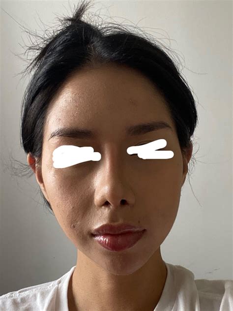 3weeks Post Op Rplasticsurgery