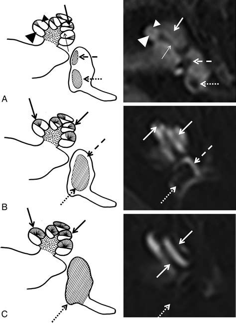 Endolymphatic Hydrops Mri Imaging Detection Of Endolymphatic Sac