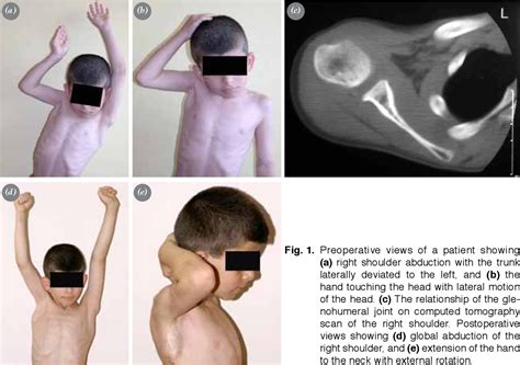 Shoulder Abduction External Rotation