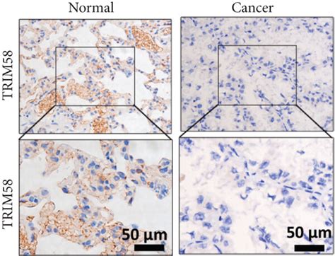 Significant Trim58 Downregulation In Nsclc Was Observed A