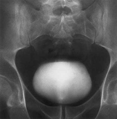 Intravenous Urography Radiology Reference Article Radiopaediaorg