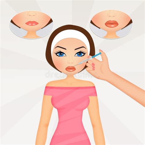 Lips Injection Lip Augmentation Injectable Cosmetic Filler Vector