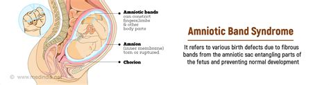 Amniotic Band Syndrome Causes Risk Factors Symptoms Diagnosis