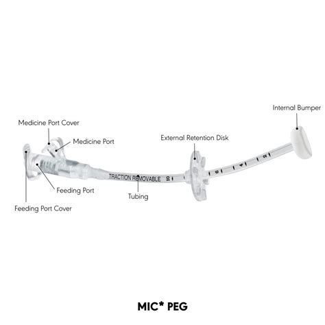 Percutaneous Endoscopic Gastrostomy Tube Peg Tube Tubefed