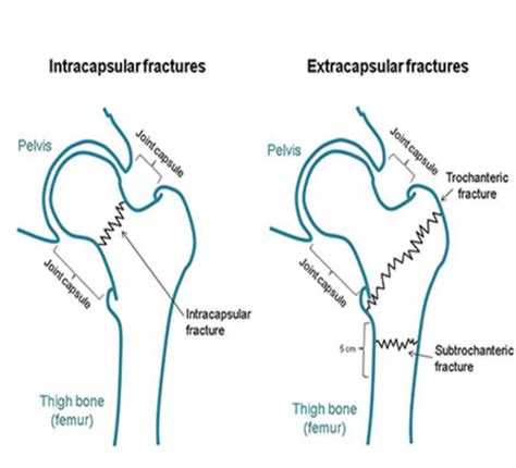 Hip Fractures Exam 3 Flashcards Quizlet