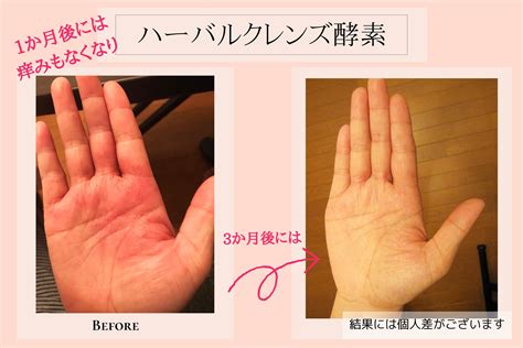 アトピーの痒みが改善された症例について：ハーバルクレンズ酵素 ハーバルデトックスラボ公式ショップ