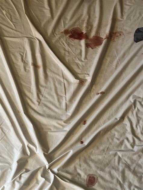 Pilonidal Cyst Rpilonidalcyst