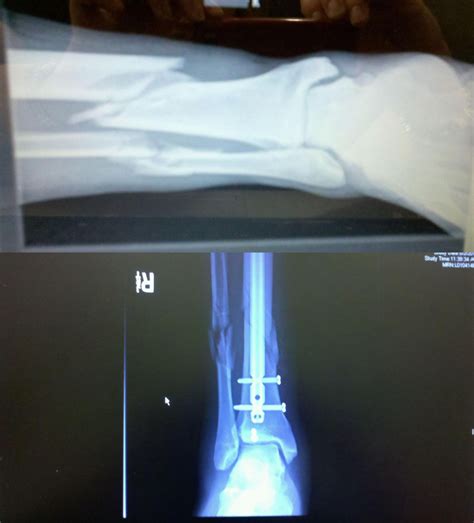 Tib Fib Fx From A Semi Pro Football Game Before And After Thanks To
