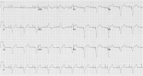 Pacemaker Rhythms Normal Patterns Litfl Ecg Library Diagnosis