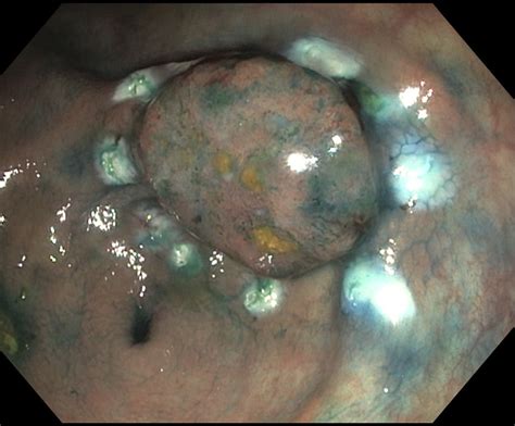 Cecal Polyp After Thermal Markings In Preparation For Fullthickness