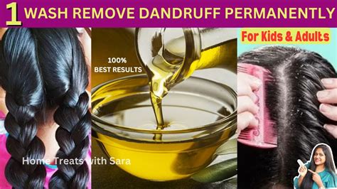 How To Treat Dandruff At Home In 1st Wash Remove Dandruff Permanently