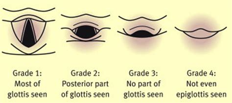 Adult Airway Evaluation In Oral Surgery Oral And Maxillofacial