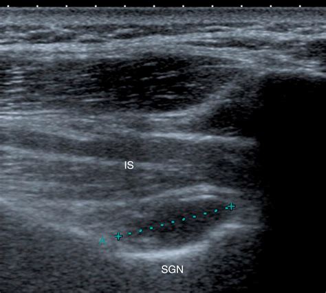 Suprascapular Nerve Block Clinical Tree