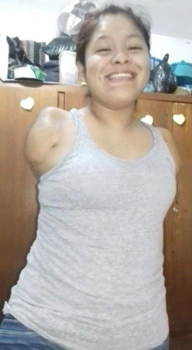 Amputee Dsd Girl Xhamster