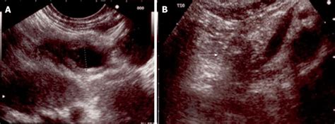 Endoscopic Ultrasound Appearances Before A And After B Treatment