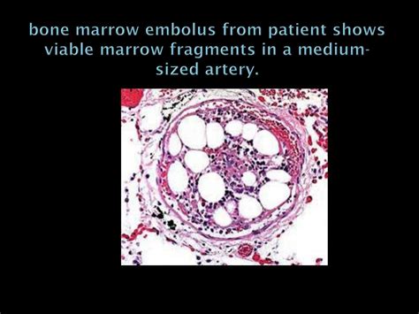 Ppt Embolism Powerpoint Presentation Free Download Id2253187