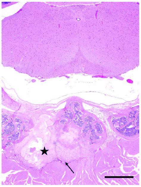 Example Of Avulsion Fracture Of The Axis 2nd Cervical Vertebra