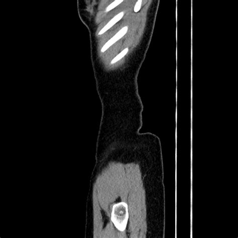 File Crohns Disease Terminal Ileitis Fistulizing Radiopaedia 98245