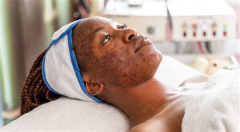 7 Reasons Your Skin Is Suddenly Getting Darker And How To Prevent It