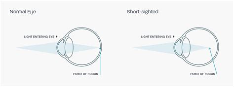 Myopia Glasses Direct™