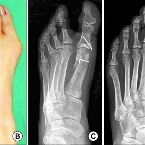 The Right Foot Of 46 Year Old Female Shows Moderate Hallux Valgus
