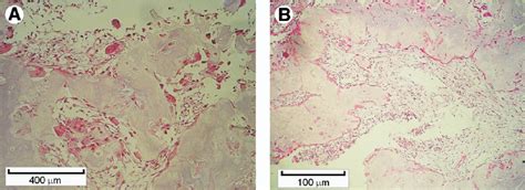 Histologic Features Of The Lesion Osteoid Matrix Producing And Highly Download Scientific