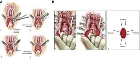 Perineal Tear Classification