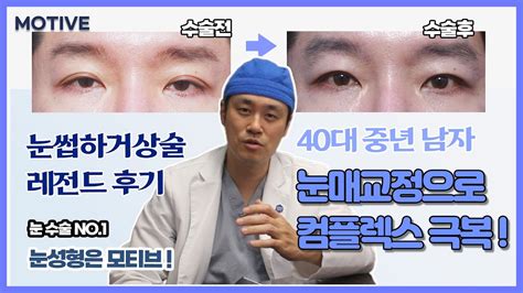40대 중년 남자 눈매교정으로 컴플렉스 극복 후기 눈썹하거상술 전후사진 Youtube
