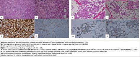 the pathological specimens of axillary lymph node and bone marrow
