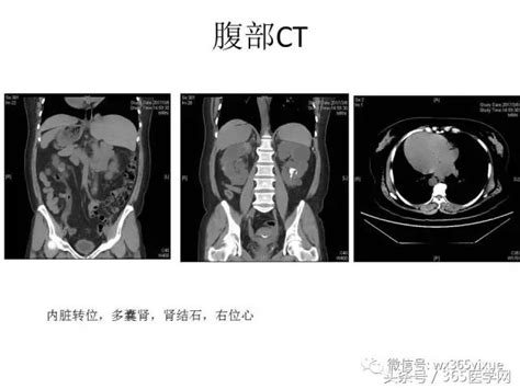 熱點課件張萍右位心伴內臟轉位頻發室早一例 每日頭條