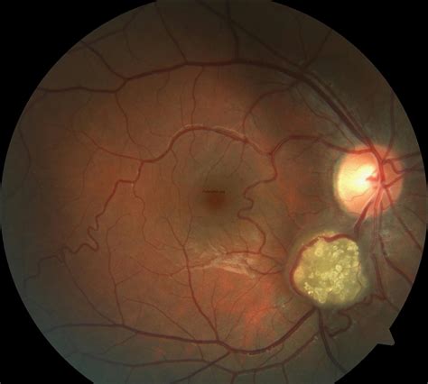 Retinal Astrocytoma In Tuberous Sclerosis Retinara