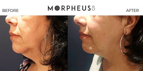 Morpheus8 Microneedling