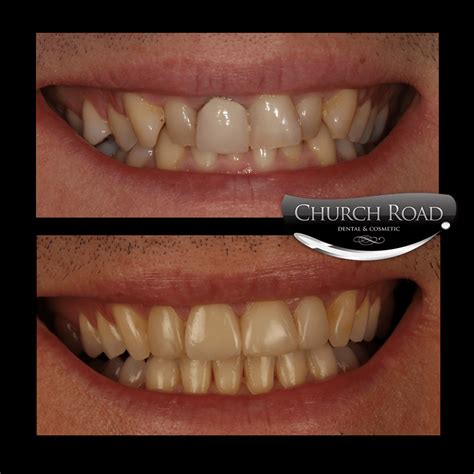 Composite Veneers Pros And Cons