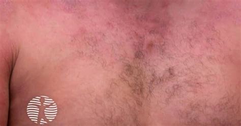 Contact Allergic Dermatitis Of The Torso Image