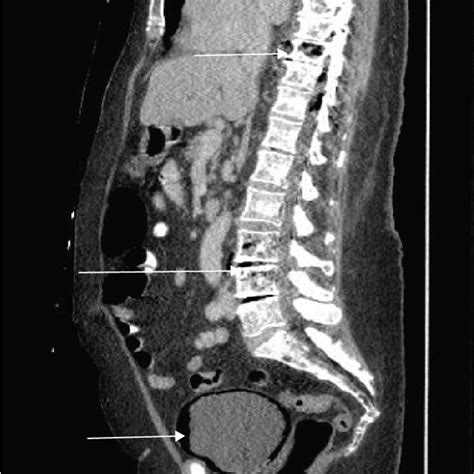 Saggital Section On Ct Showing Emphysematous Cystitis And Pneumoracchis