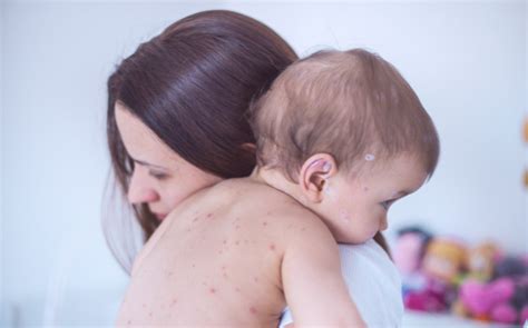 过敏寻麻疹反反复复怎么办？结果是满意的！ 知乎