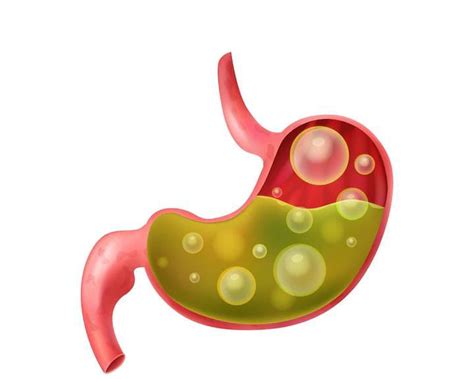 Gastritis Bahayakah Ini Dia Pencegahan Dan Pengobatannya Mediaperawatid