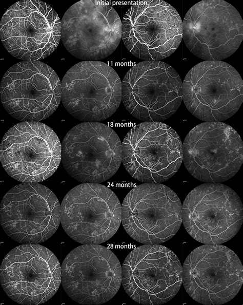 Application Of Fluorescence Angiography At Jenenge Blog