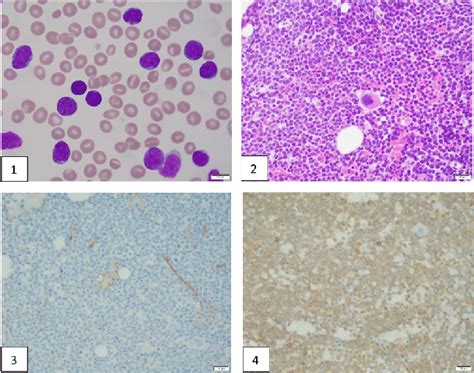 Fig A 12 Bone Marrow Aspiratebiopsy Showing Hypercellular Marrow