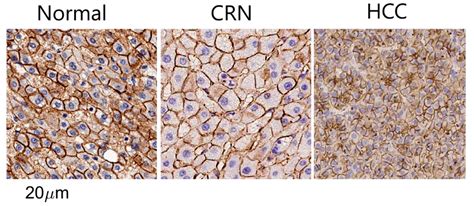 Distinguishing Hepatocellular Carcinoma From Cirrhotic Regenerative Nodules Using Mr Cytometry