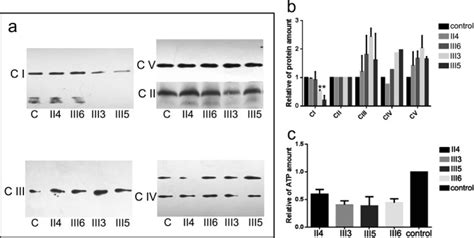 Bilateral Striatal Necrosis Due To Homoplasmic Mitochondrial 3697g A Mutation Presents With