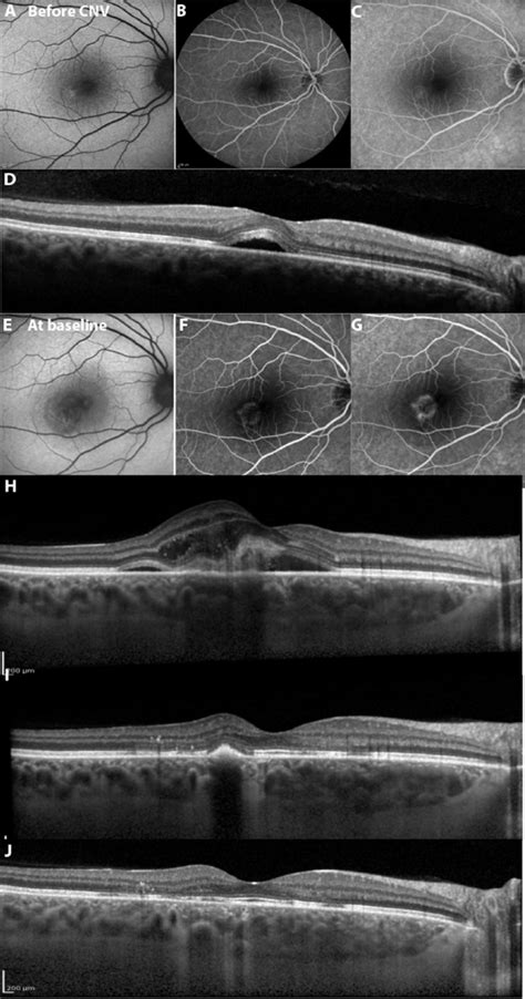 A 45 Year Old Man A Known Case Of Cscr Presented With A Chief