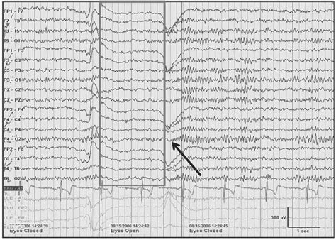 Normal Adult Eeg Thoracic Key