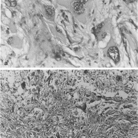 A Ground Glass Appearance Ofmultinucleated Giant Cells Also Download Scientific Diagram